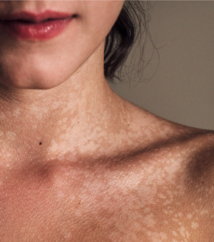 Prévenir et atténuer les taches brunes et l’hyperpigmentation